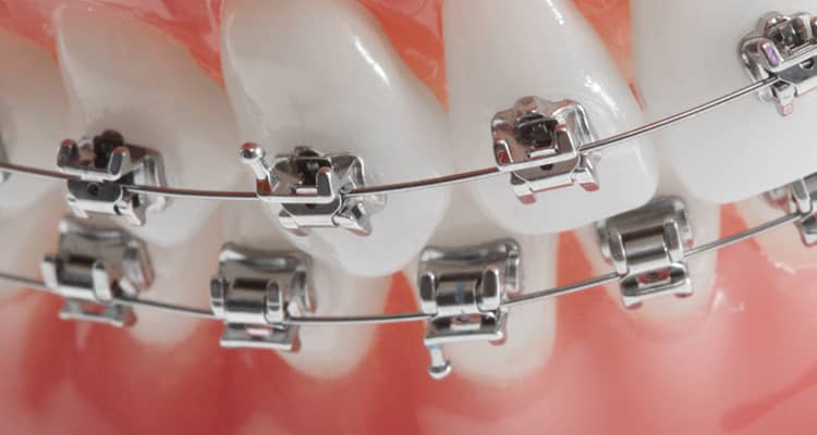 brackets_autoligado | Clínica Ortodoncia Exclusiva Rafael Gallardo