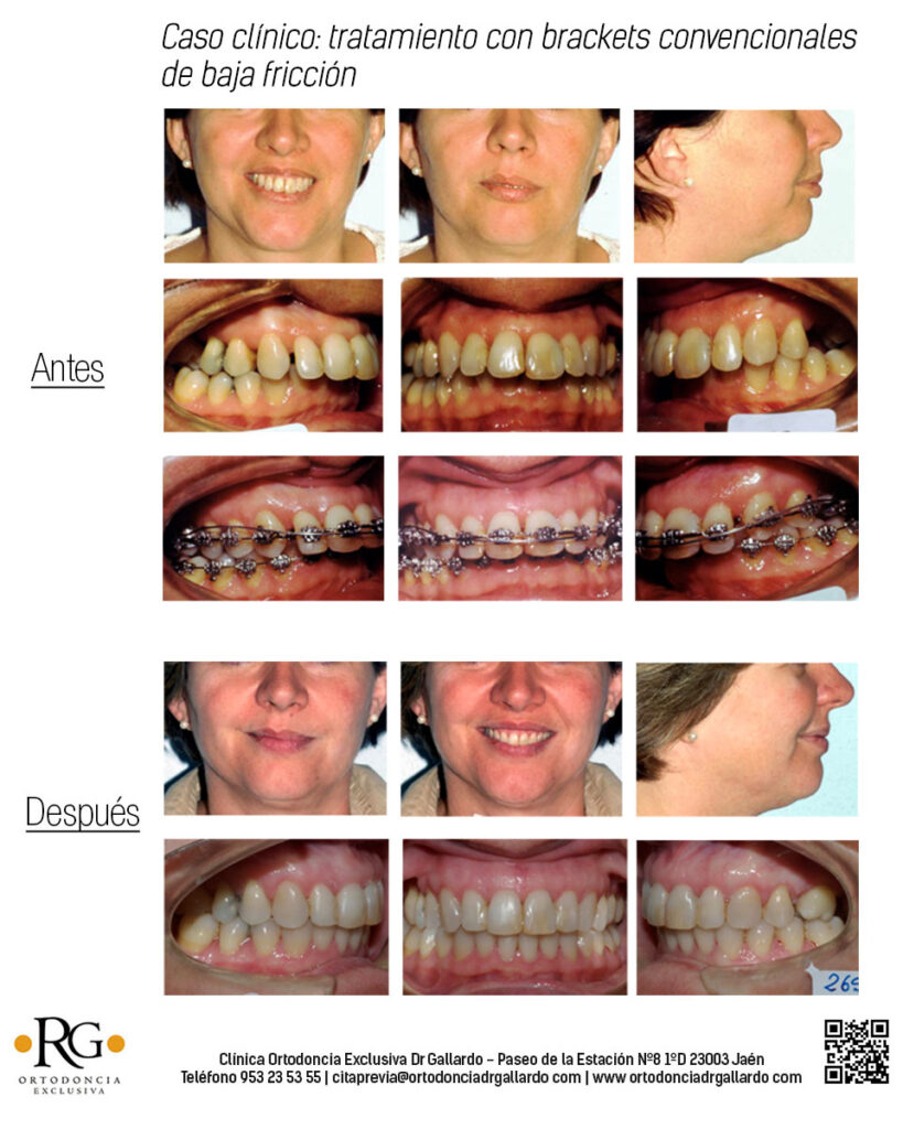 Brackets convencionales | Clínica Ortodoncia Exclusiva Rafael Gallardo