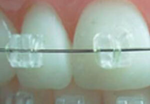 Tratamiento con brackets estéticos | Clínica Ortodoncia Exclusiva ...