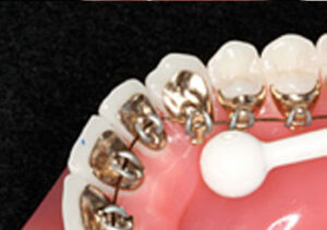 TRATAMIENTOS CON BRACKETS LINGUALES | Clínica Ortodoncia Exclusiva ...