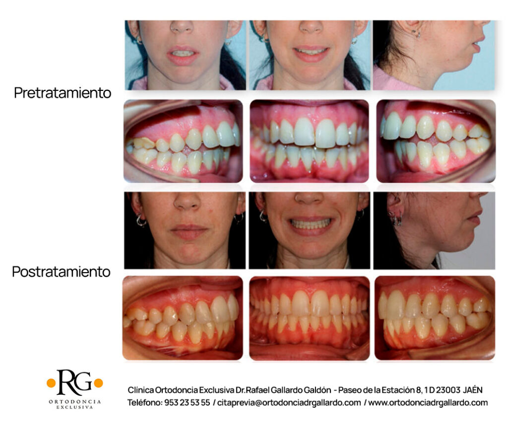 Caso con reabsorción condilar tratado con Ortodoncia y Cirugía ...